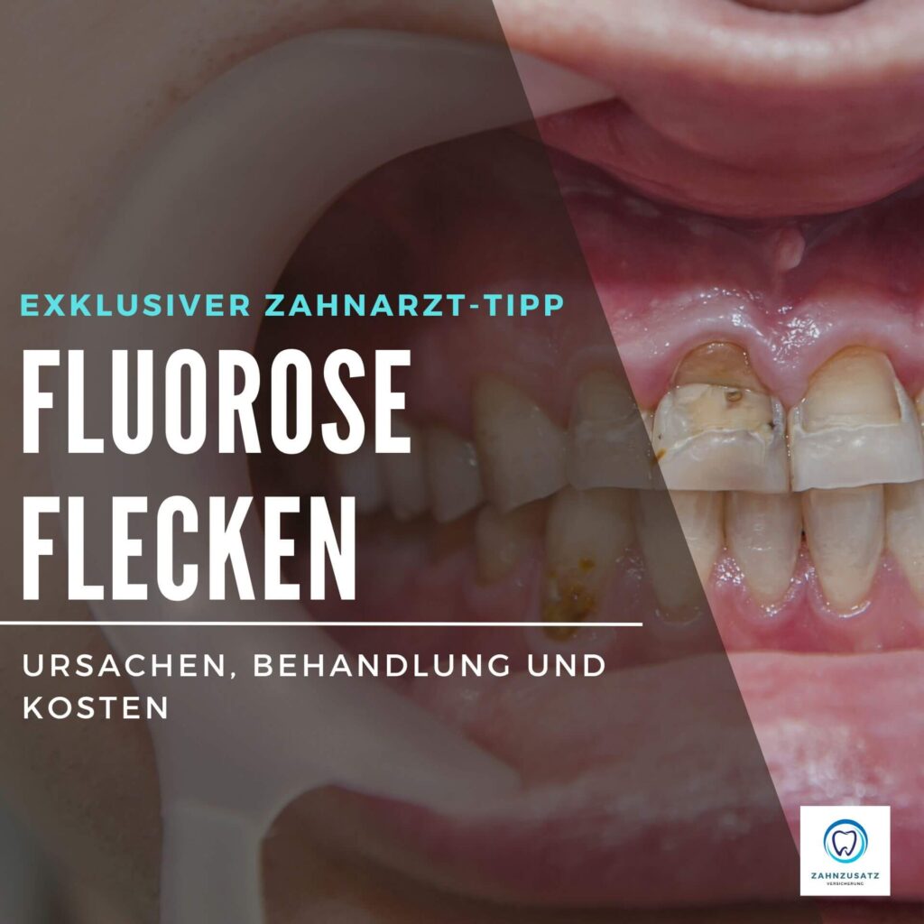 ᐅ Teleskopprothese: Funktion, Behandlung & Reinigung