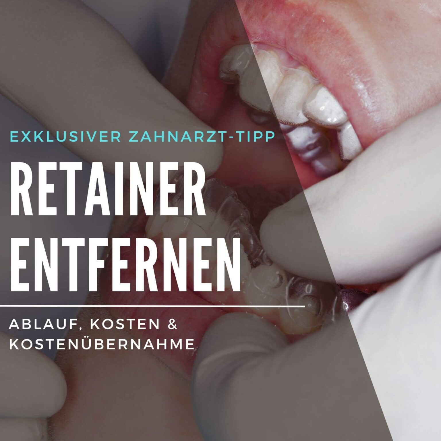 ᐅ Retainer entfernen: Ablauf, Kosten & Kostenübernahme
