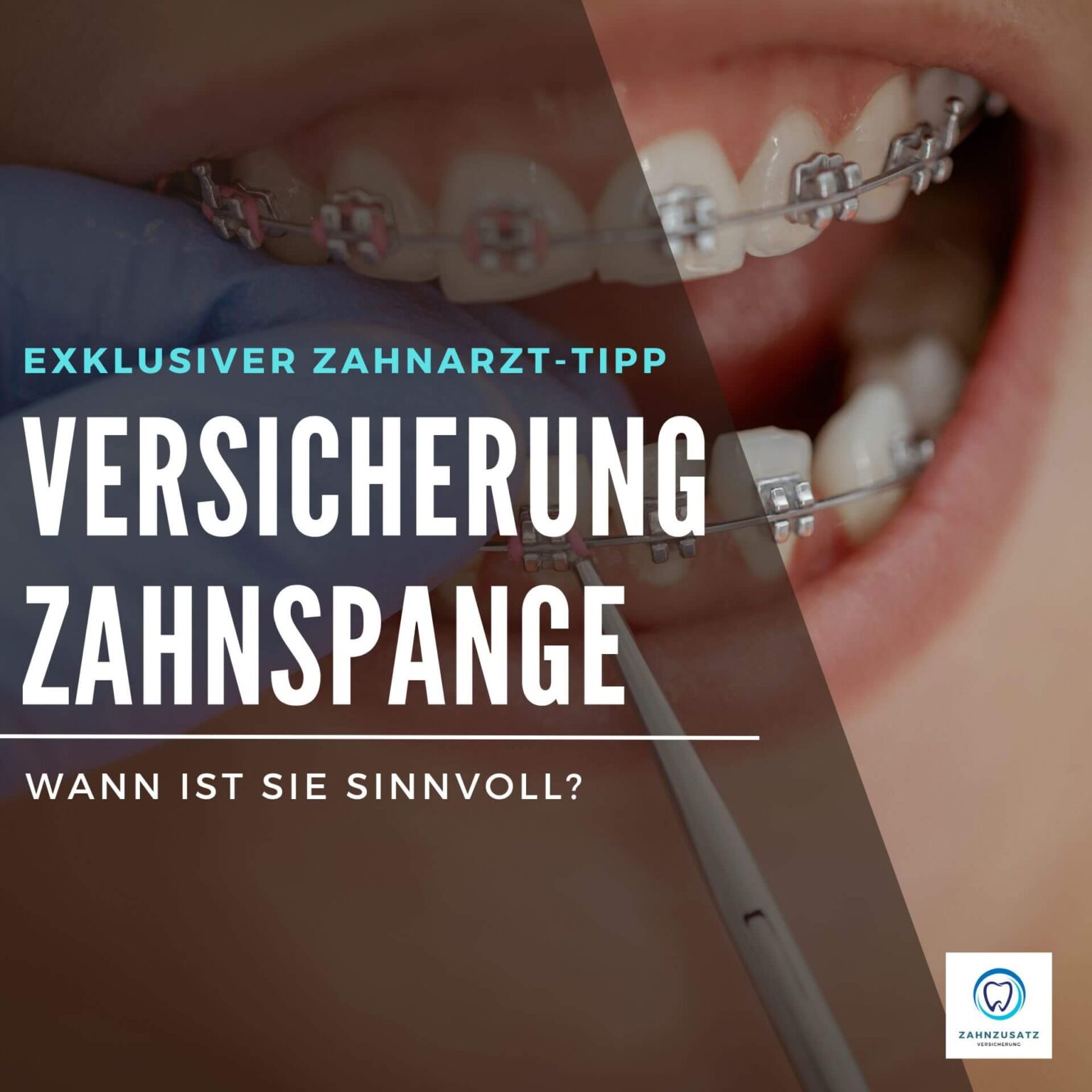 Faszinierend Zhne Versiegeln Kinder Nachteile Bildernull