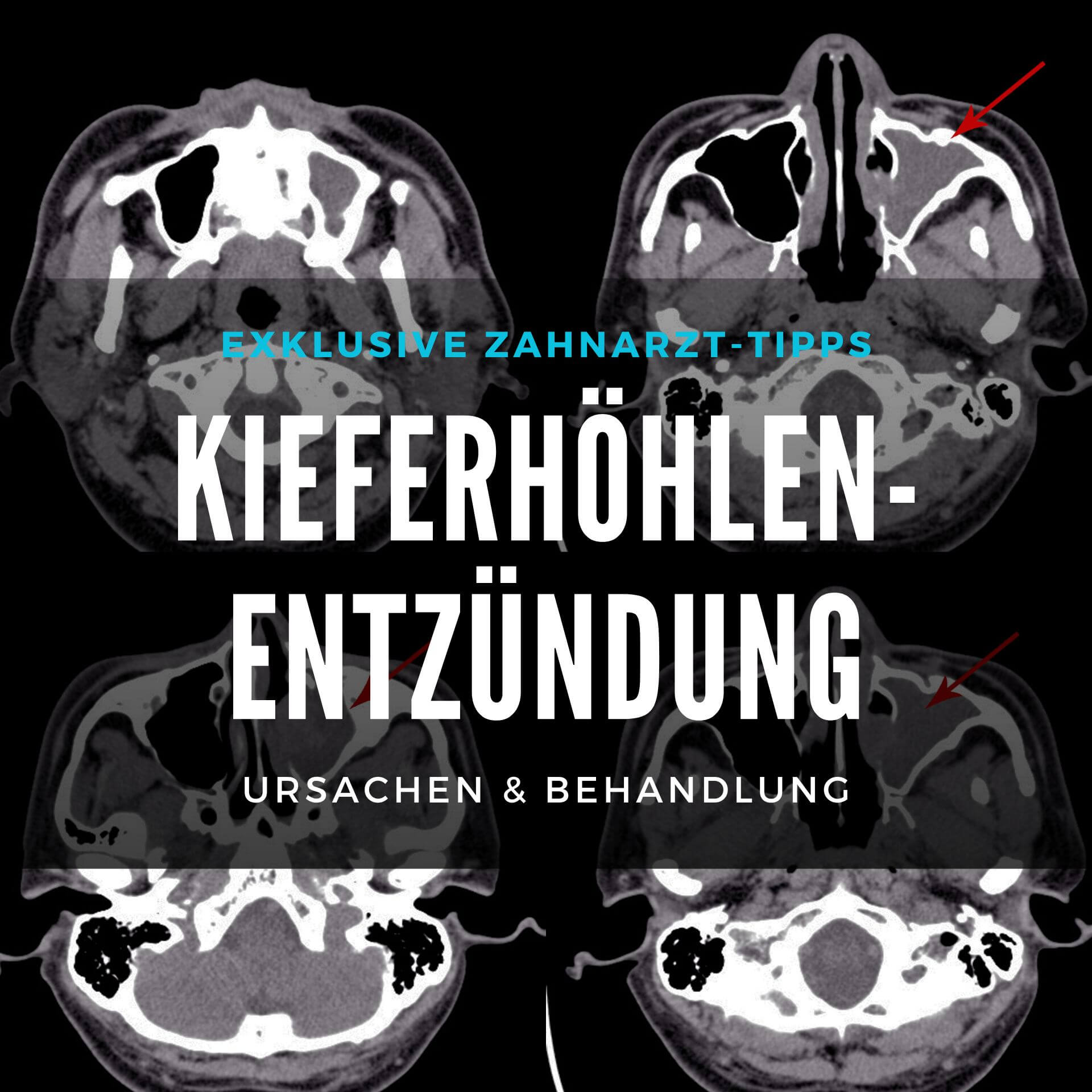 Initialkaries: Frühe Erkennung & effektive Prävention
