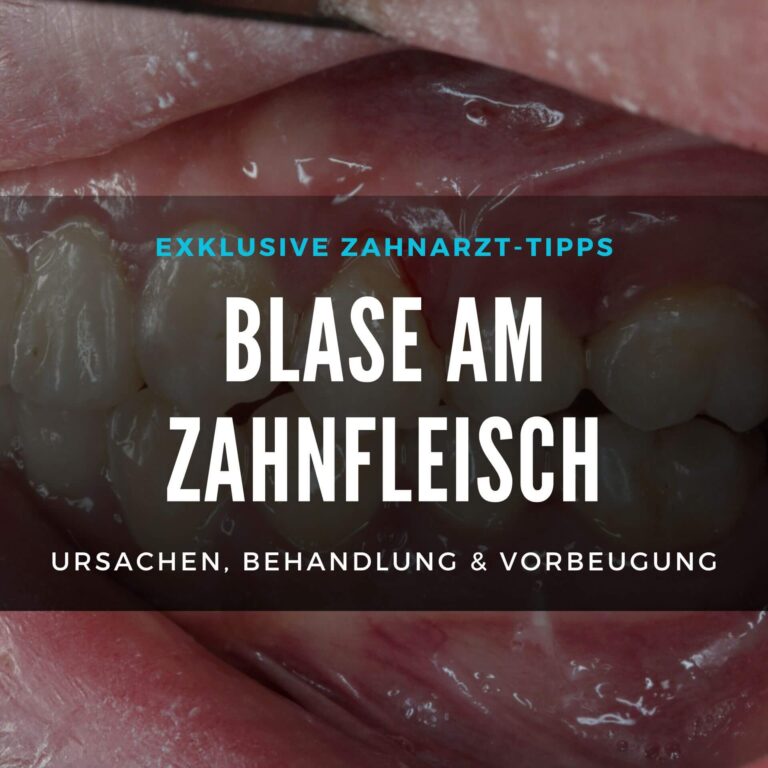 Blase am Zahnfleisch: Ursachen, Behandlung & Vorbeugung