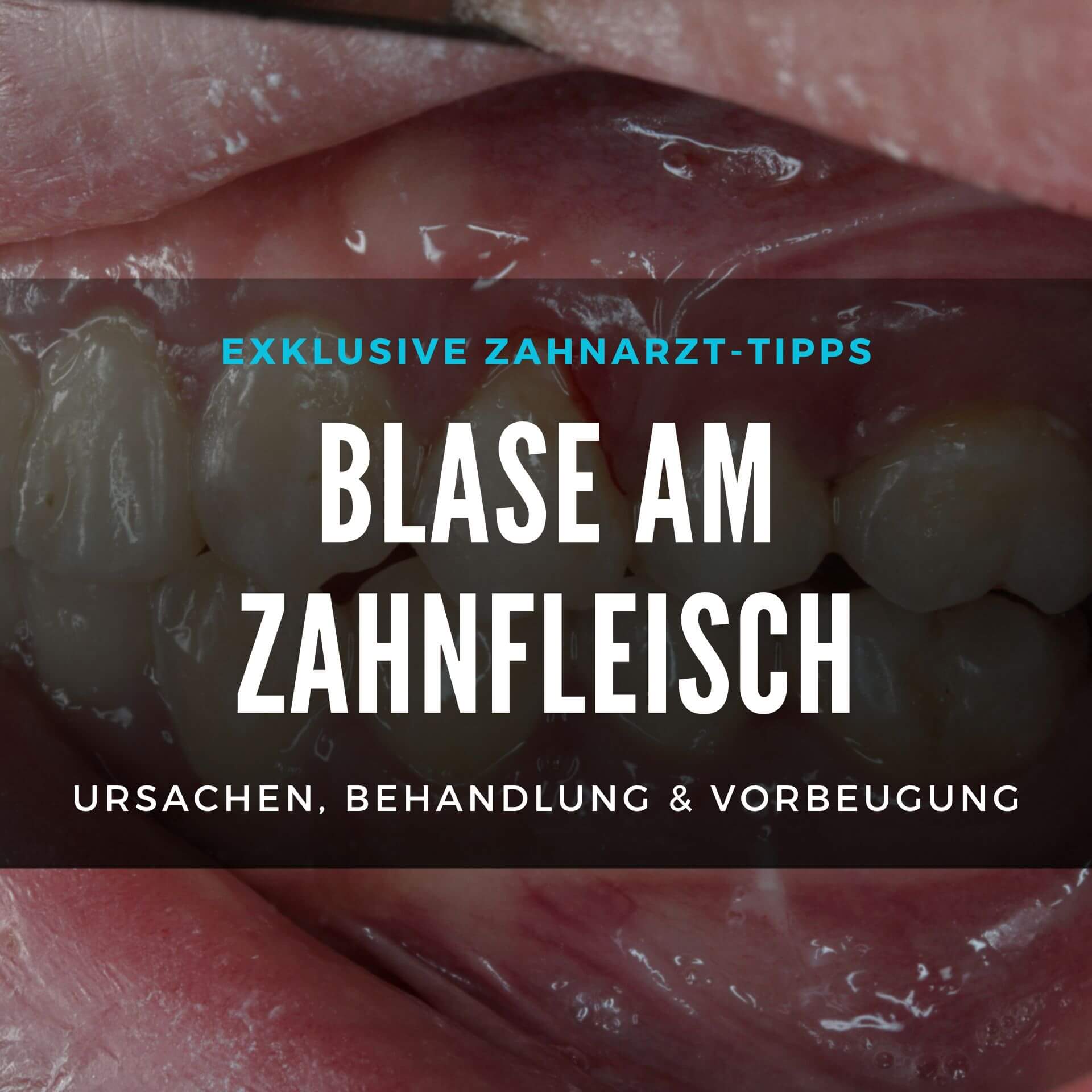 Blase am Zahnfleisch: Ursachen, Behandlung & Vorbeugung