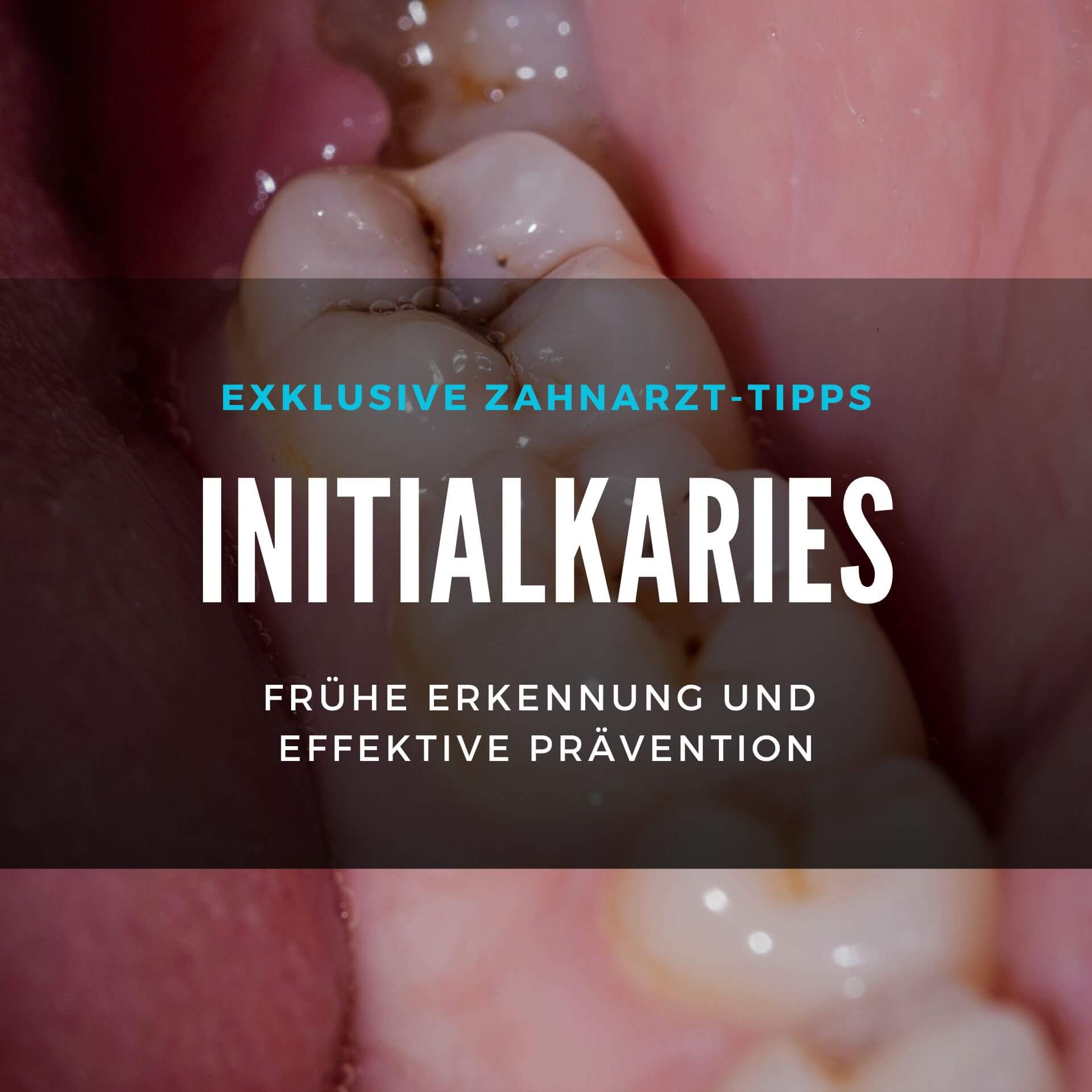 Initialkaries: Frühe Erkennung & effektive Prävention