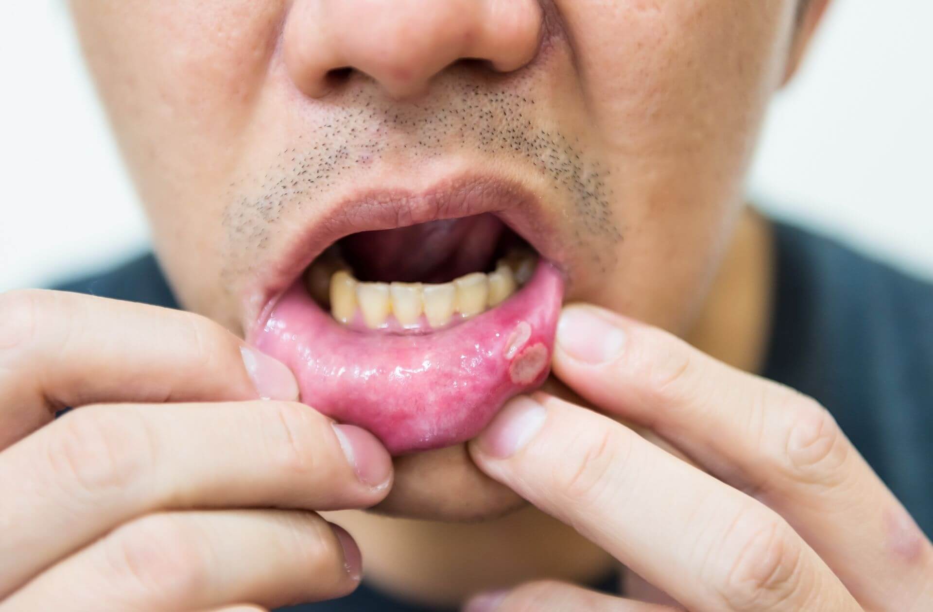 Aphten im Rachen: Ursachen, Behandlung und Vorbeugung