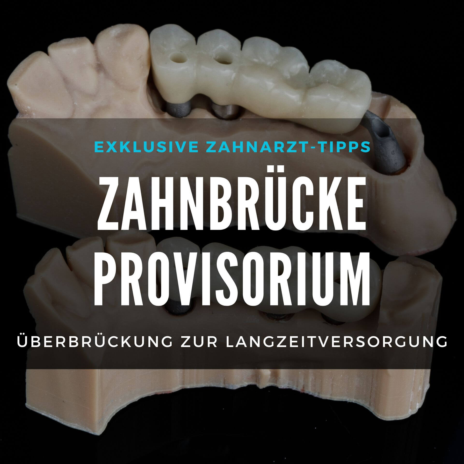 Zahnbrücke Provisorium: Überbrückung bis zur Langzeitversorgung