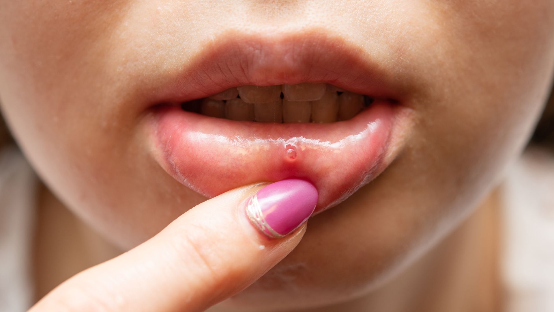 ᐅ Stomatitis aphthosa: Ursachen, Symptome & Behandlung